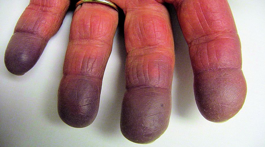 ¿Qué es la enfermedad de Buerger? - Prensa Antártica